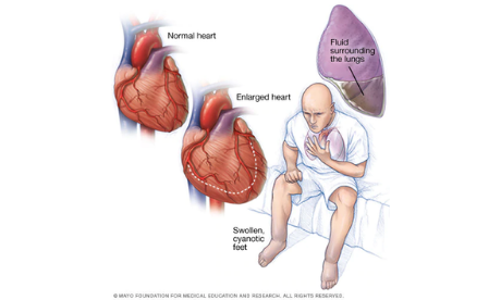 Καρδιακή ανεπάρκεια - η νόσος με τη σταδιακά αυξανόμενη ...